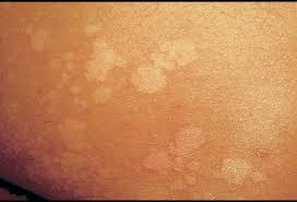 Pitiriasis Versicolor: Penyakit Kulit