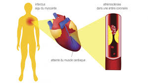 英和画像辞典：(infarctus)の関連画像一覧！