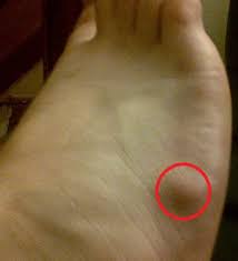 Ganglion Cyst Removal Toe