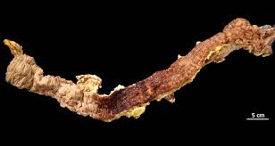 Pathology Outlines - Ulcerative colitis